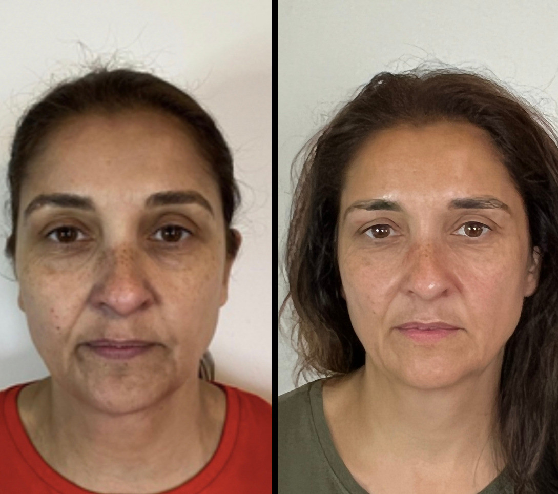 Radio Frequency Facial | Chloe's Annex | Skin Tightening | Eye Bags ...