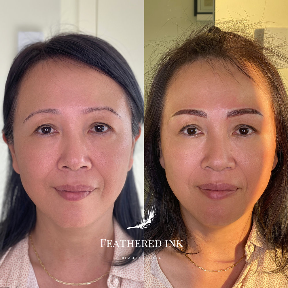 Case Study: Correcting Brow Asymmetry