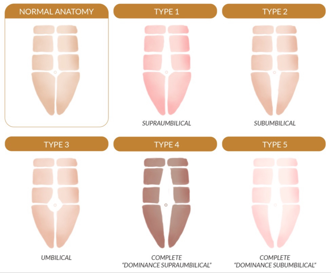 Os Tipos De Diástase: Entendendo as Diferenças e Características
