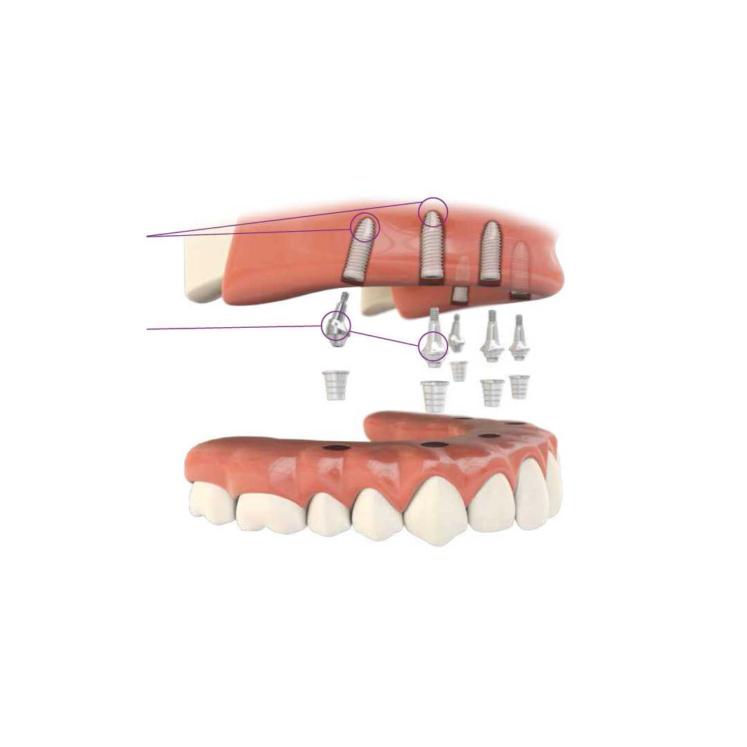 Teeth in One Day | 3rdSET Dental Implants | United States