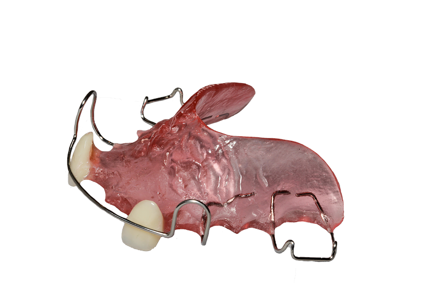 REMOVABLE RETAINERS | orthoassistus