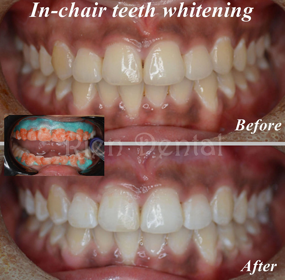 In-chair teeth whitening