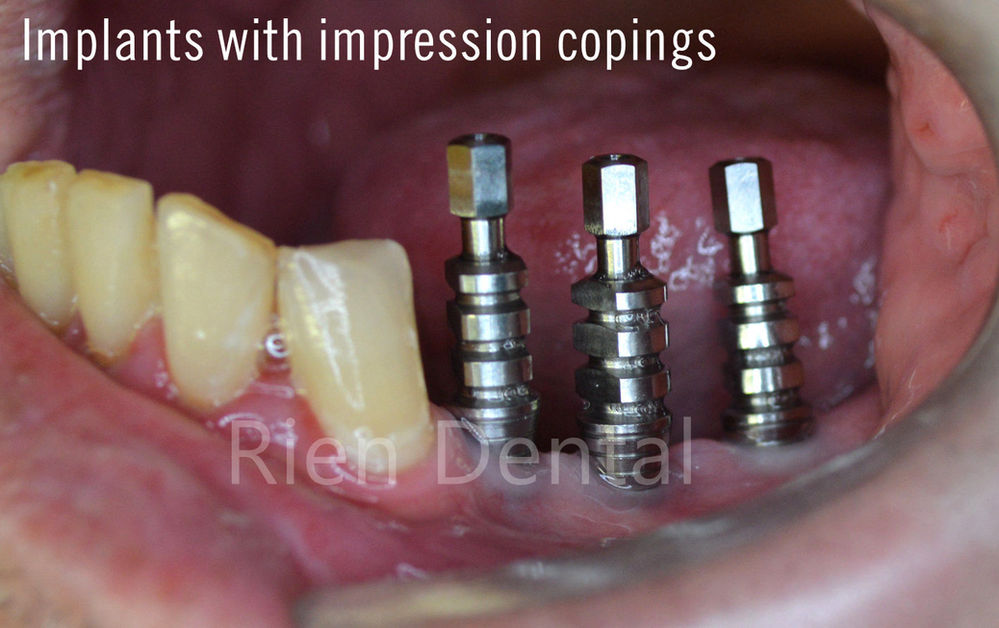 Multiple Dental Implants