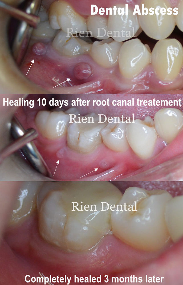 Healing of dental abscess and success of root canal treatment.
