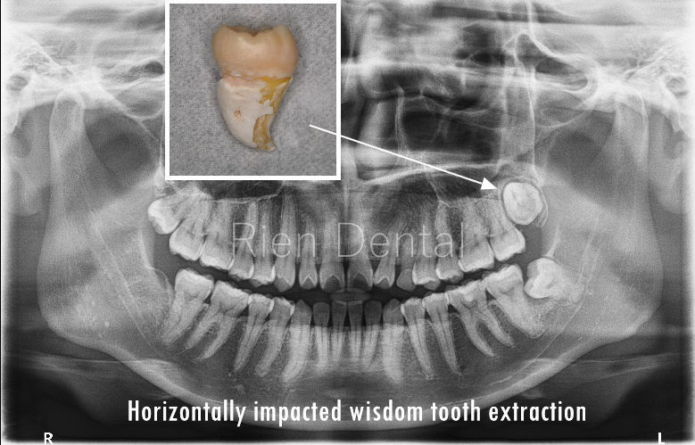 Fully buccolingually impacted wisdom tooth.