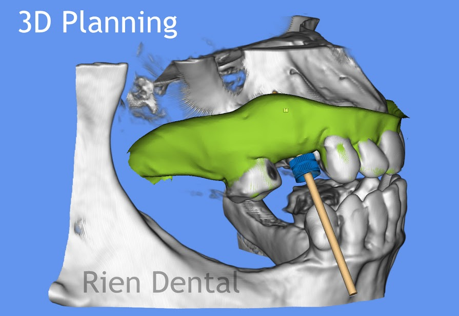 Computer guided implant surgery - step by step