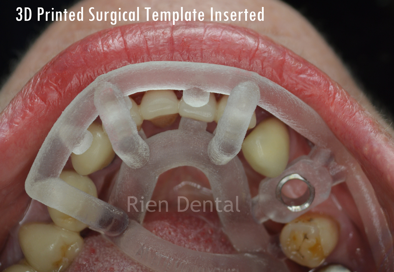Computer Guided Implant Surgery - Rien Dental