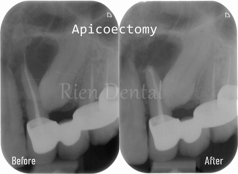 Apicoectomy - root canal surgery.