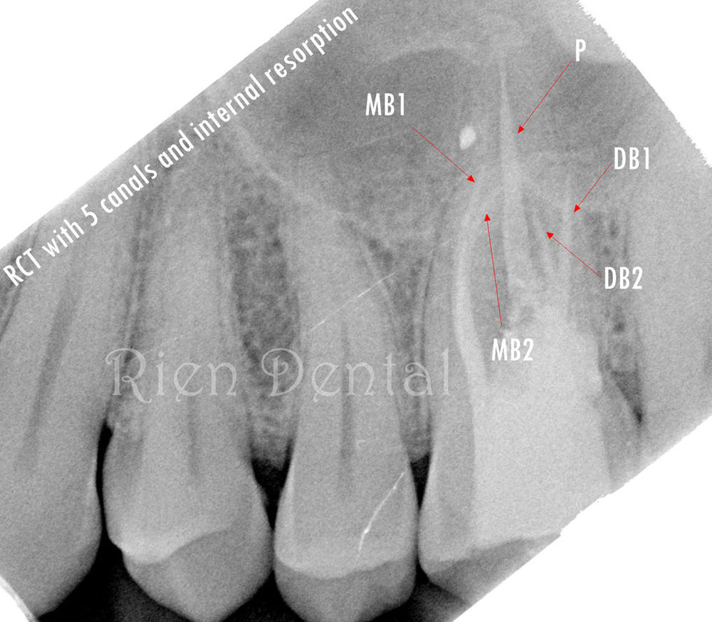 Internal tooth resorption - root canal treatment with 5 canals.