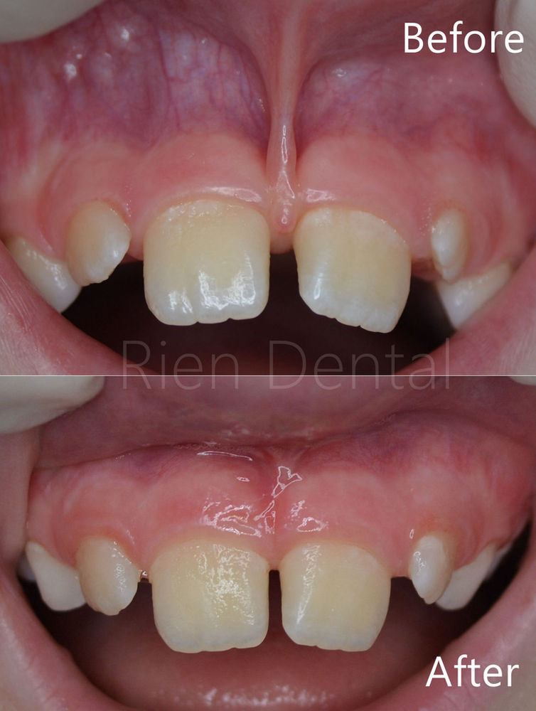 Maxillary Labial Frenectomy