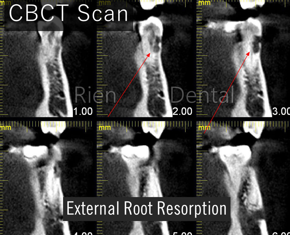 External Root Resorption.