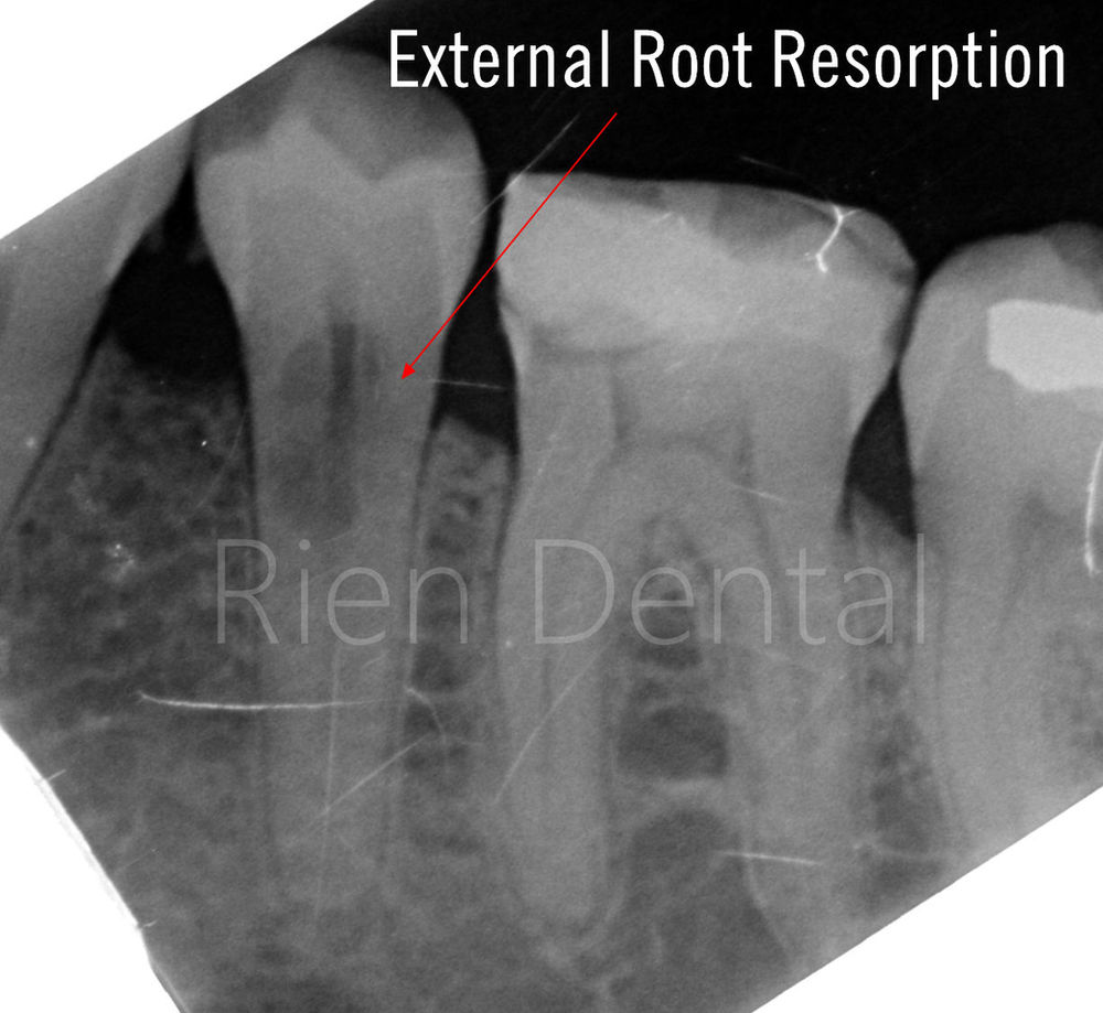 External Root Resorption.
