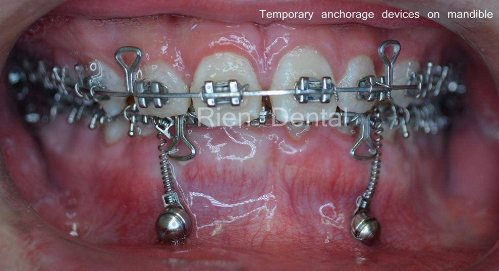 Temporary anchorage devices - TADs