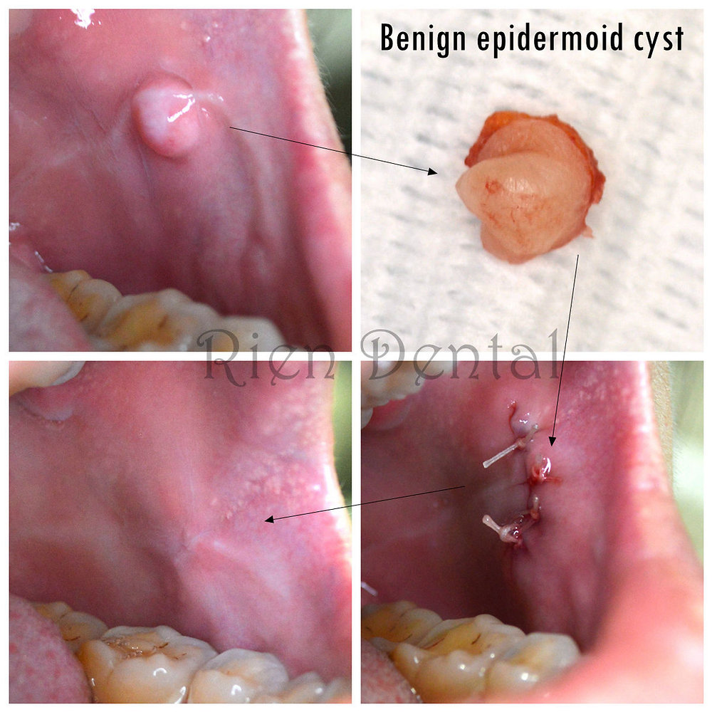 Epidermoid Cyst In Cheek Epidermoid Cyst In Cheek