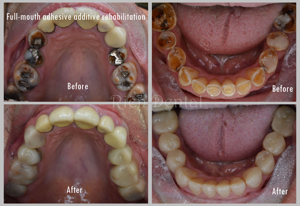 Full-mouth rehabilitation of the worn dentition.