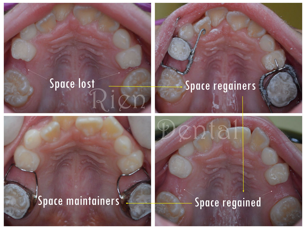 Loose space - regain space - maintain space.