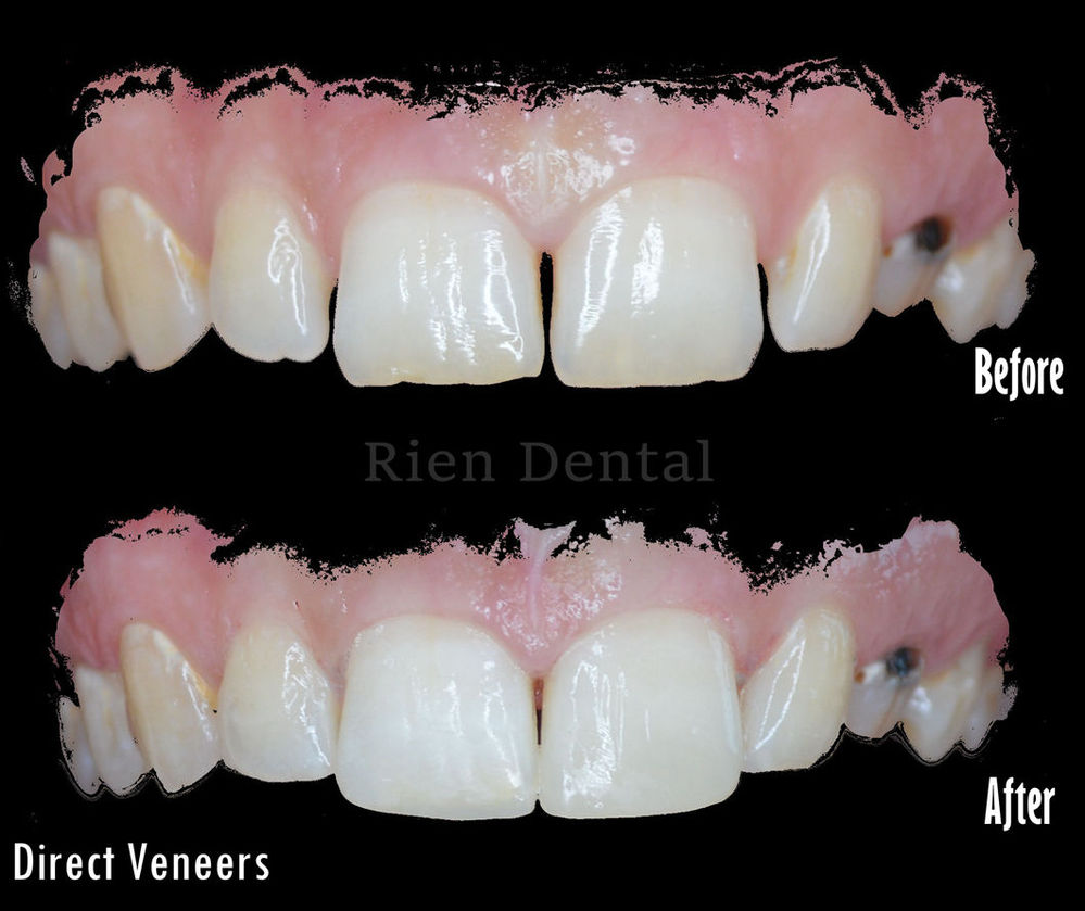 Direct Veneers - Composite Veneers