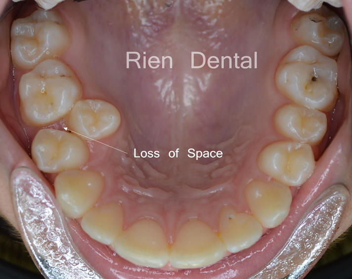 Consequence of early loss of baby tooth