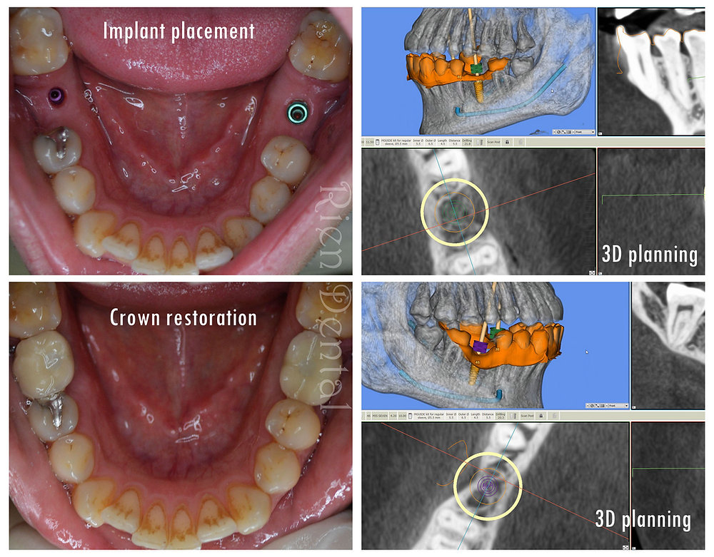 2 implants to replace 2 missing lower molars