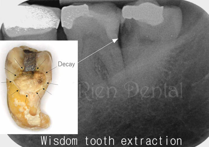 Wisdom tooth extraction