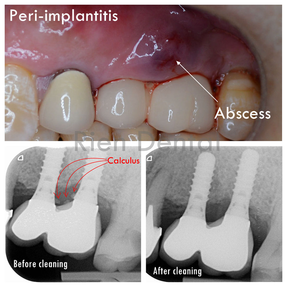 Peri-implantitis