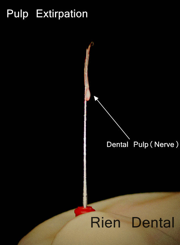This is where toothache comes from - Dental nerve
