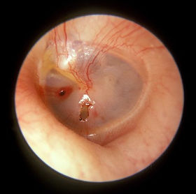manubrium eardrum
