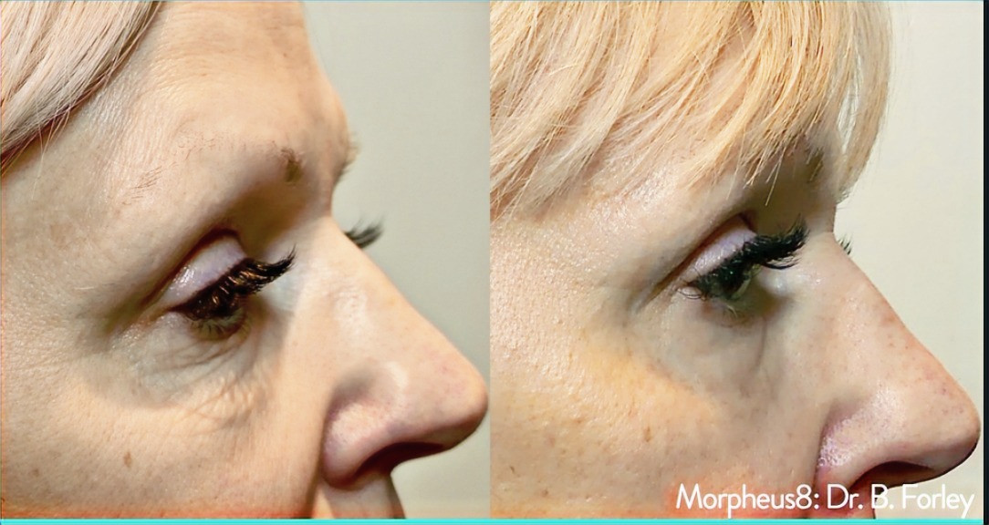 Ithaca Medical Aesthetics | Skin & Hair - Morpheus8 Face & Neck