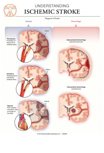 Ischemic Stroke - Anatomical Wall Chart | BSI Catalog