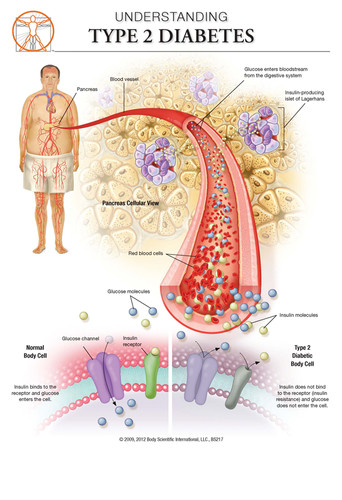 Type 2 Diabetes - Anatomical Wall Chart | BSI Catalog