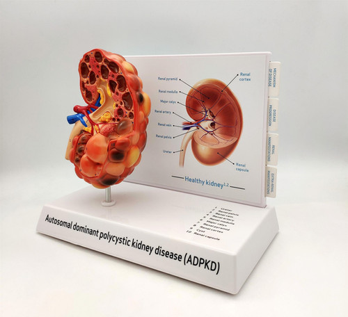 Autosomal dominant polycystic Kidney Disease (ADPKD) | BSI Catalog