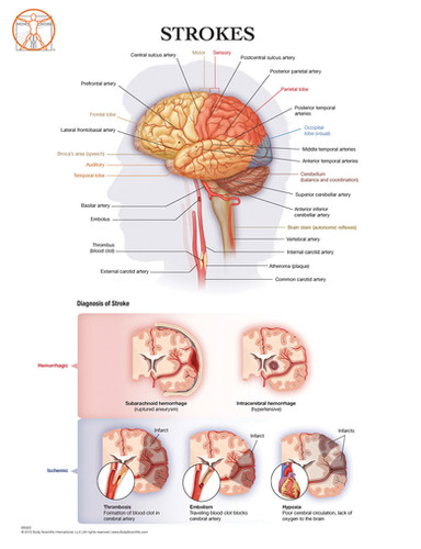 Stroke and Brain Anatomy - Anatomical Wall Chart | BSI Catalog