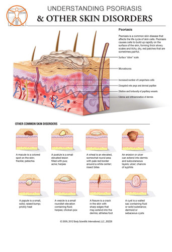 Psoriasis & Skin Disorders - Anatomical Wall Chart | BSI Catalog