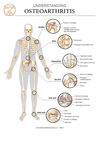 Osteoarthritis - Anatomical Wall Chart | BSI Catalog