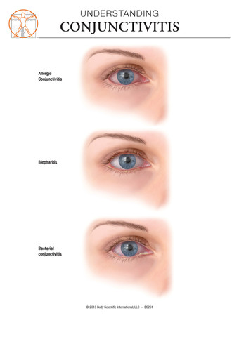 Conjuntivitis - Anatomical Wall Chart | BSI Catalog