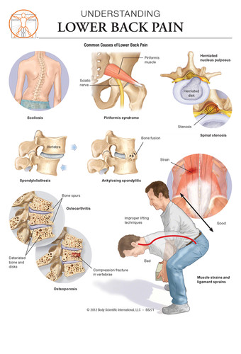 Low Back Pain - Anatomical Wall Chart | BSI Catalog