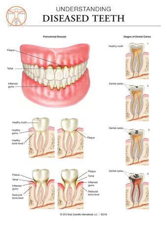 Diseased Teeth - Anatomical Wall Chart | BSI Catalog