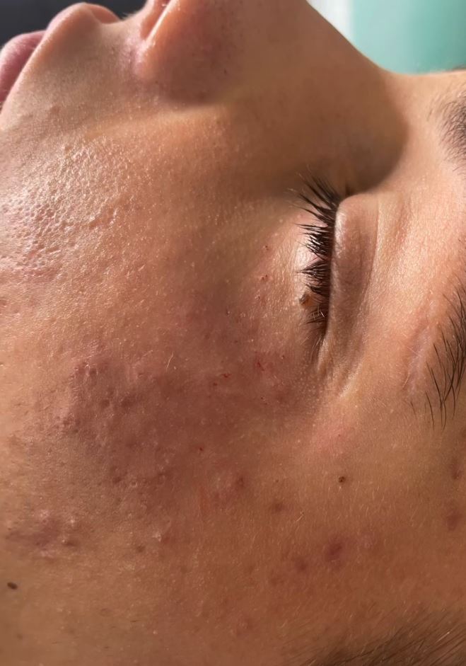 Milia 101: Defining, Extracting, and Preventing