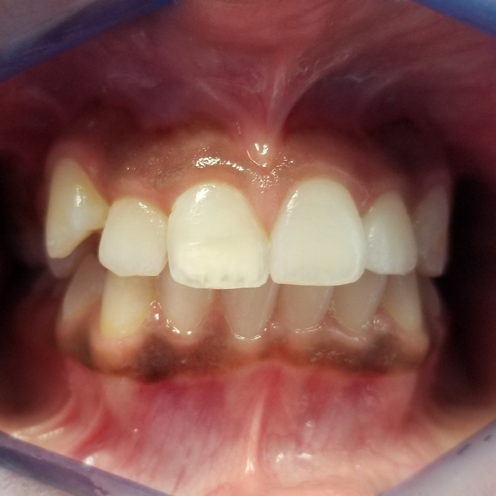 A Quick Solution to Align Your Teeth!