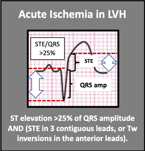 Mastering STEMI ECG