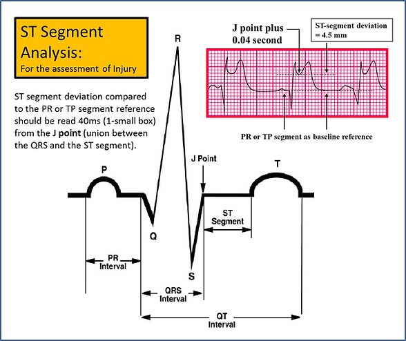 Mastering STEMI ECG