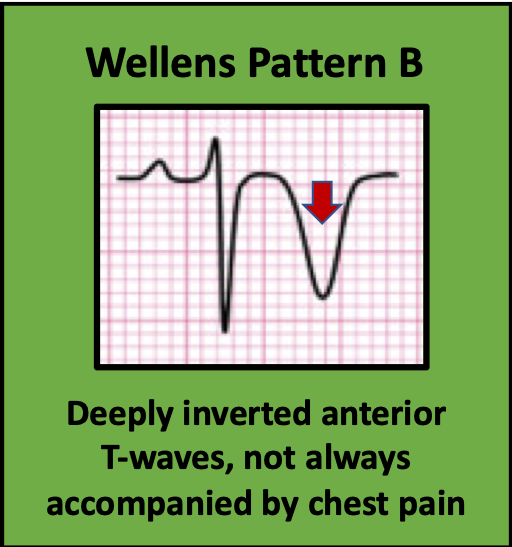 Mastering STEMI ECG