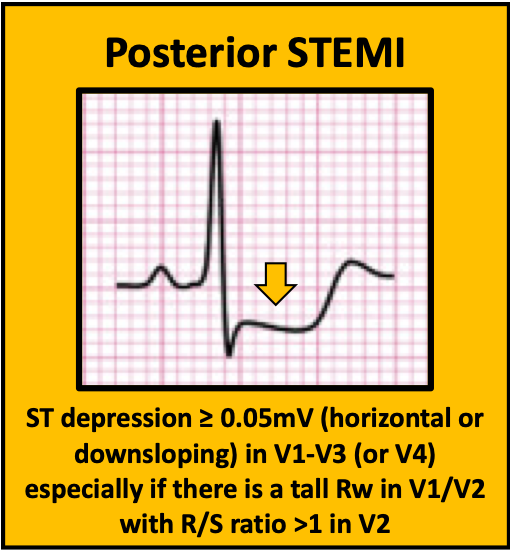 Mastering STEMI ECG