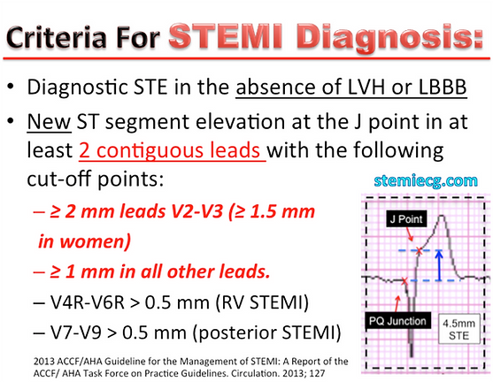 Mastering STEMI ECG