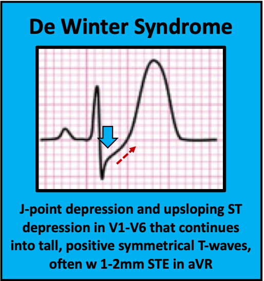 Mastering STEMI ECG