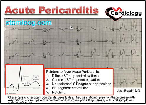 Mastering STEMI ECG