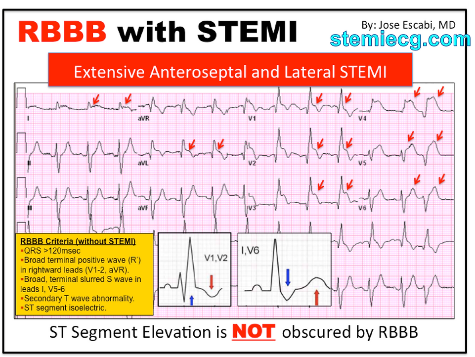 Mastering STEMI ECG