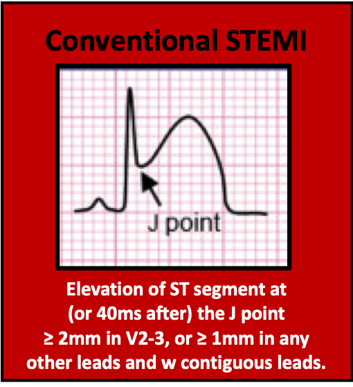 Mastering STEMI ECG