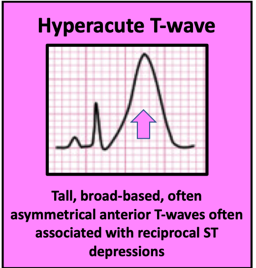 Mastering STEMI ECG