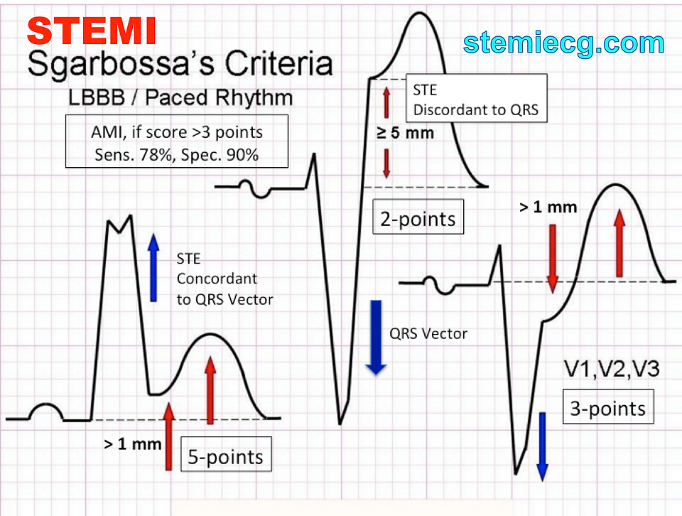 Mastering STEMI ECG